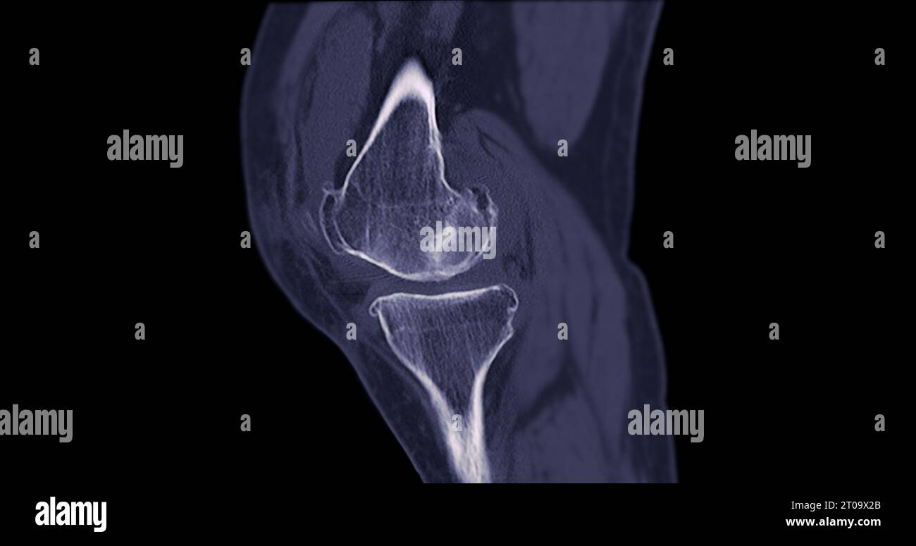 CT Scan of Knee joint for medical background Stock Photo - Alamy