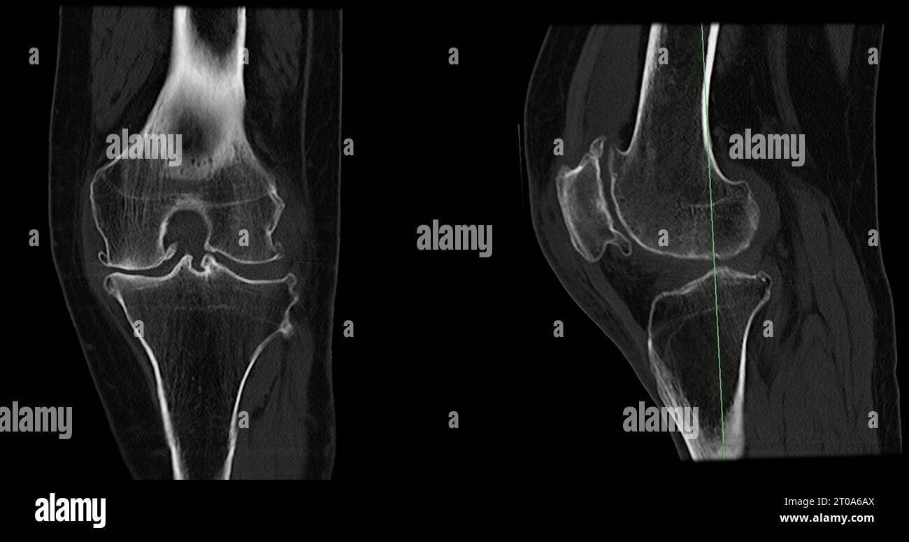 CT Scan of Knee joint for medical background Stock Photo - Alamy