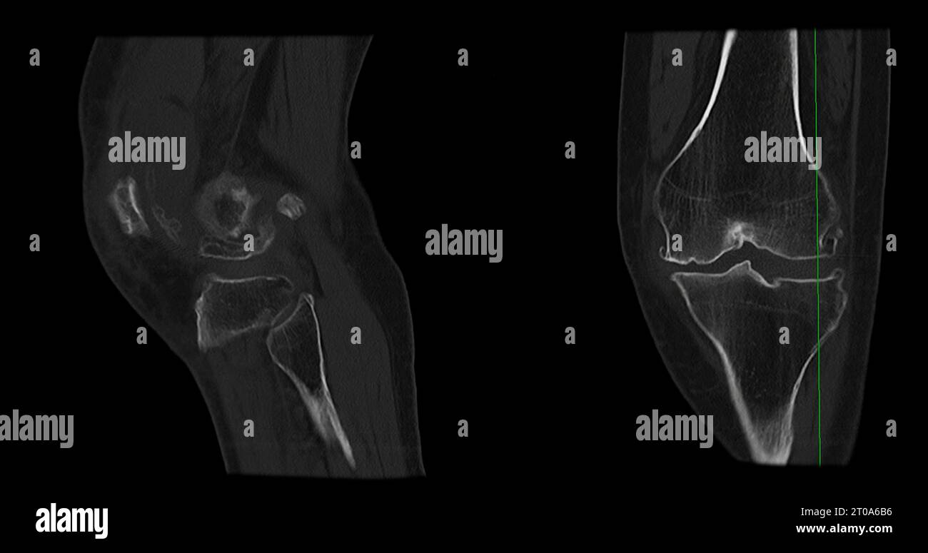 CT Scan of Knee joint for medical background Stock Photo - Alamy