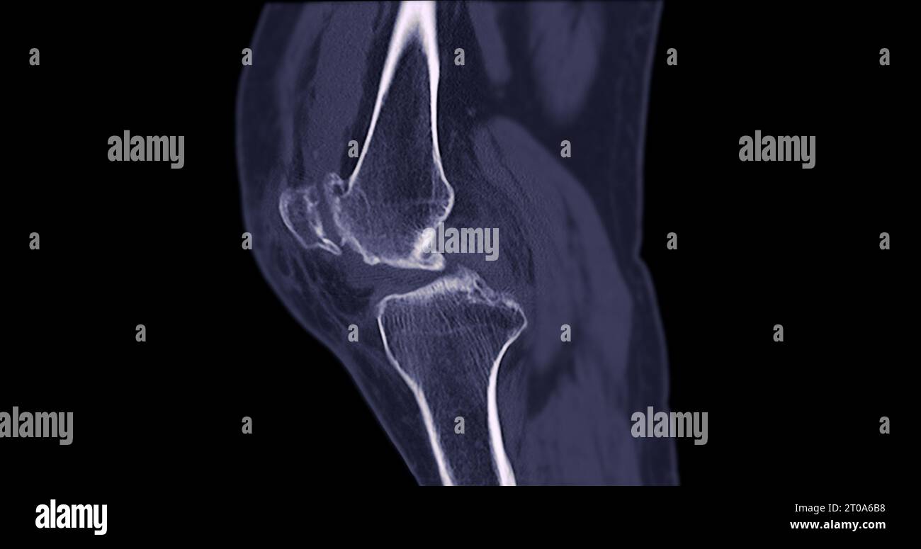 CT Scan of Knee joint for medical background Stock Photo - Alamy
