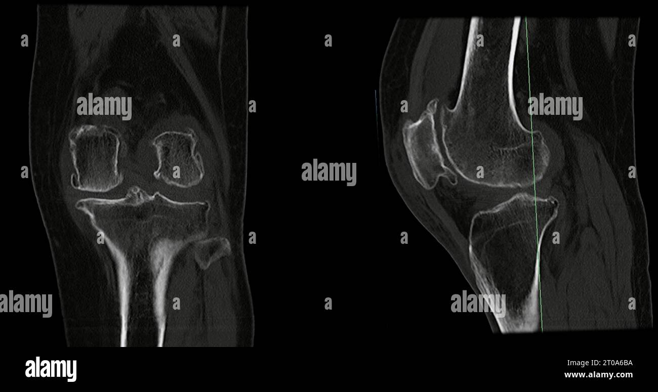 CT Scan of Knee joint for medical background Stock Photo - Alamy