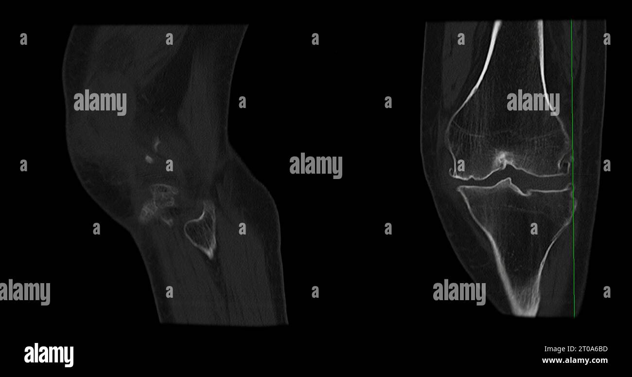 CT Scan of Knee joint for medical background Stock Photo - Alamy