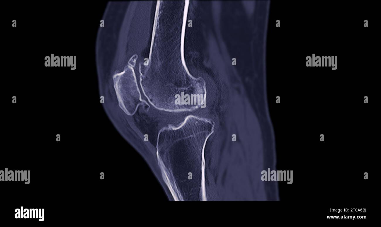 CT Scan of Knee joint for medical background Stock Photo - Alamy