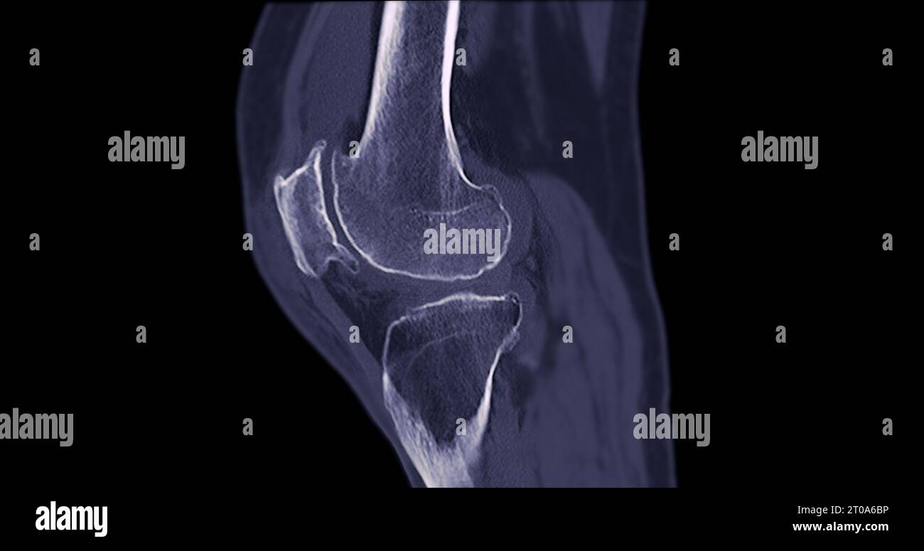 CT Scan of Knee joint for medical background Stock Photo - Alamy