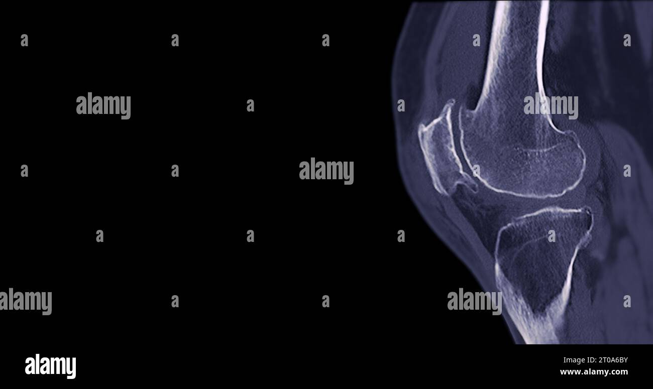 CT Scan of Knee joint for medical background Stock Photo - Alamy