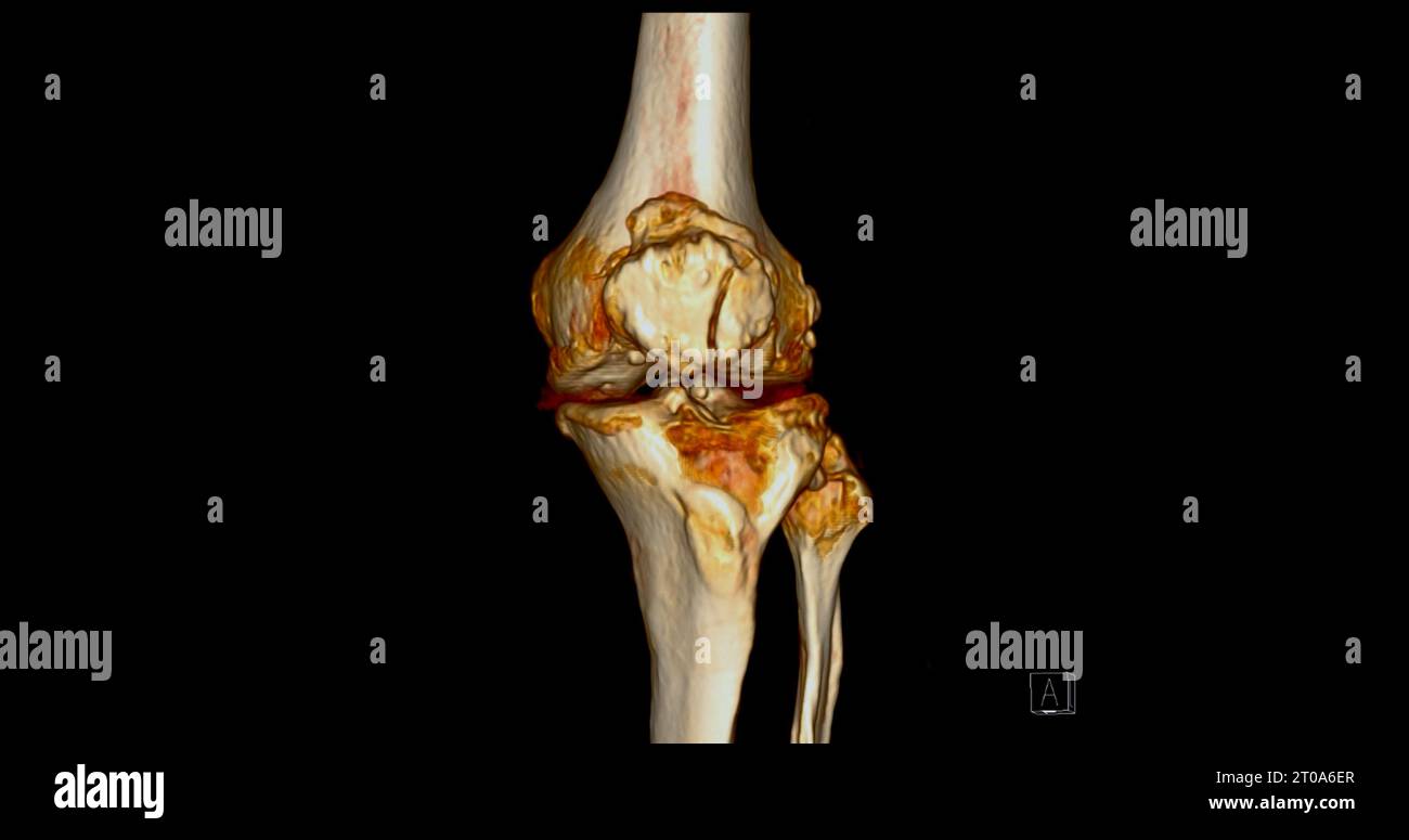 CT Scan of Knee joint showing fracture tibia and fibula bone 3D ...