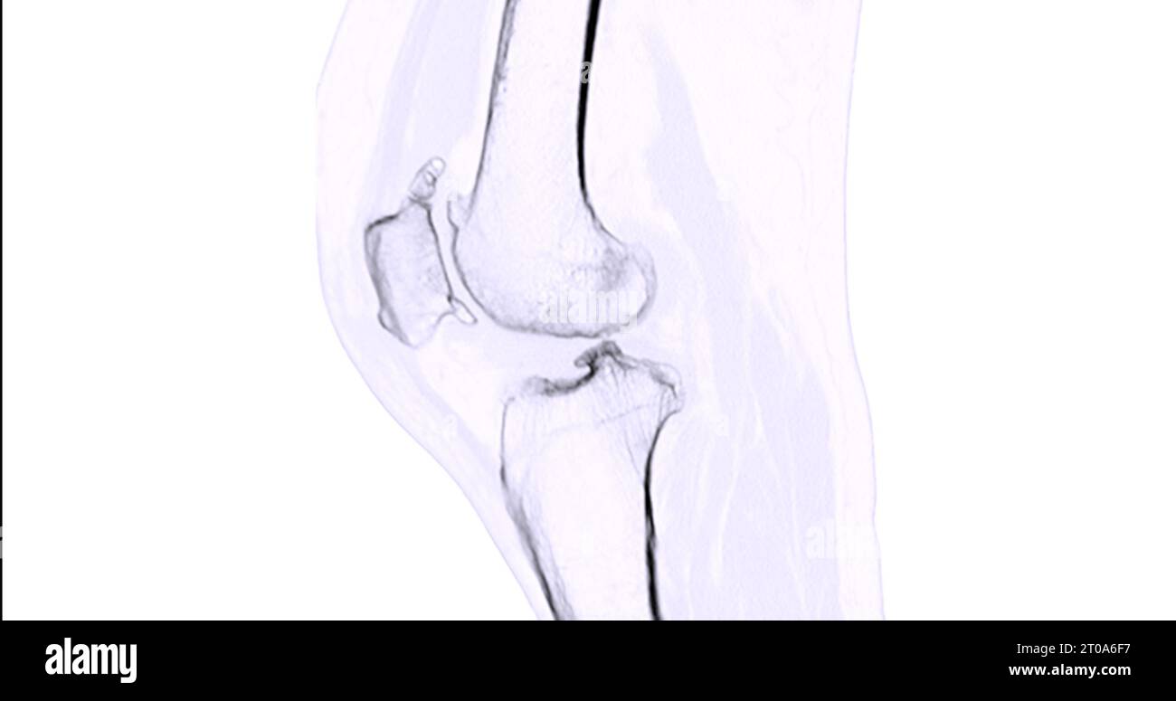 CT Scan of Knee joint for medical background Stock Photo - Alamy