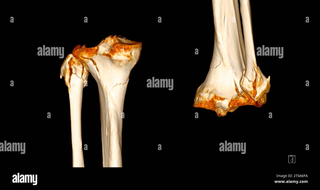 CT Scan of Knee joint showing fracture tibia and fibula bone 3D ...