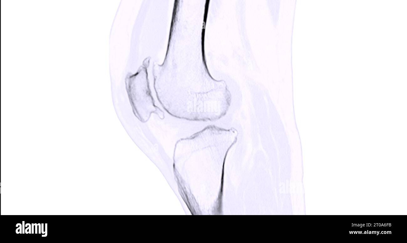 CT Scan of Knee joint for medical background Stock Photo - Alamy