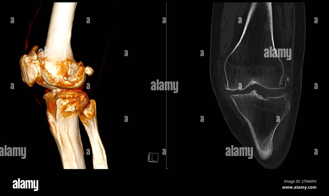 CT Scan of Knee joint showing fracture tibia and fibula bone 3D ...