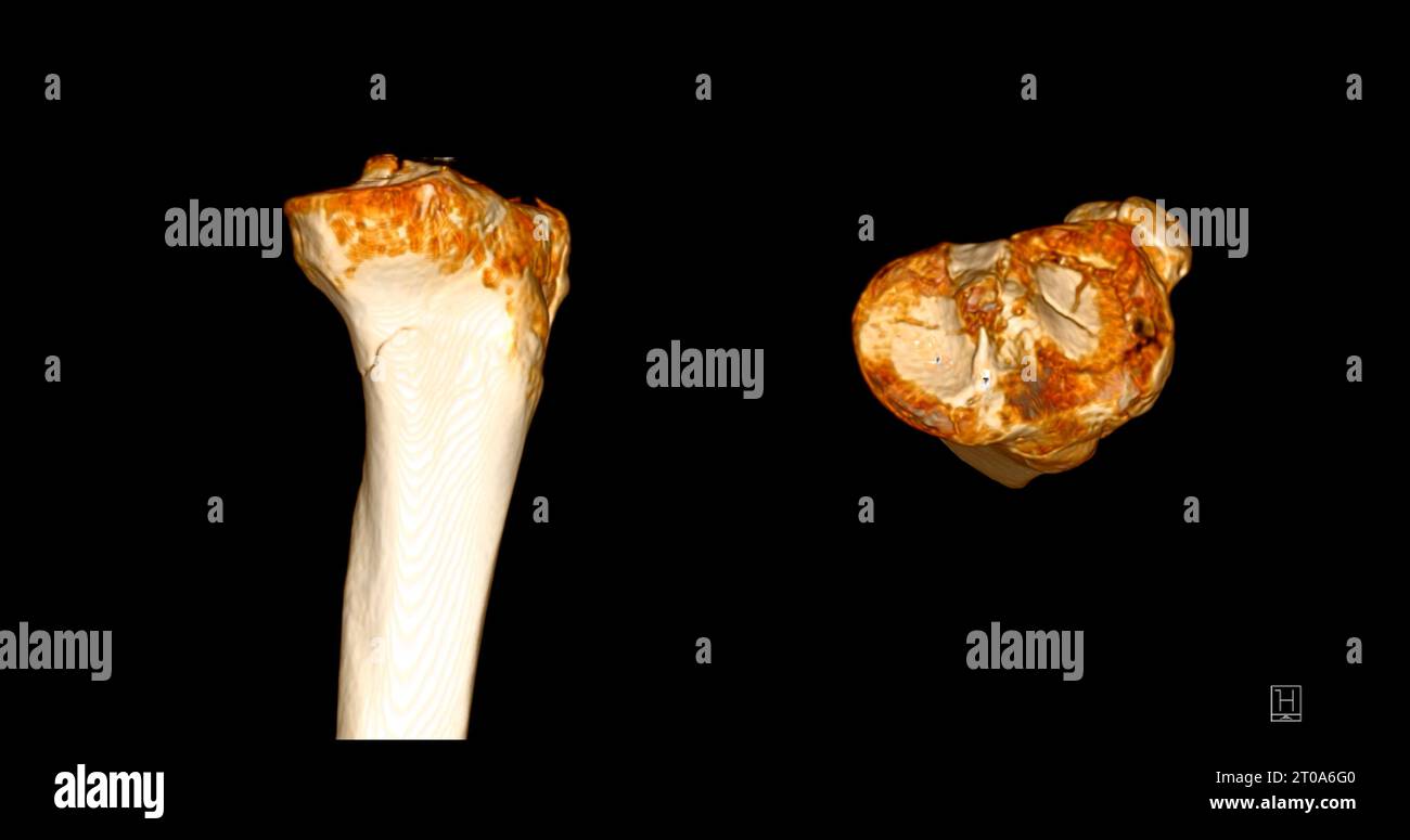 CT Scan of Knee joint showing fracture tibia and fibula bone 3D ...