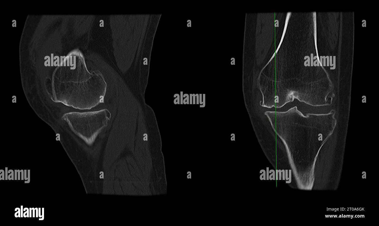 CT Scan of Knee joint sagittal and coronal in case fracture patella ...