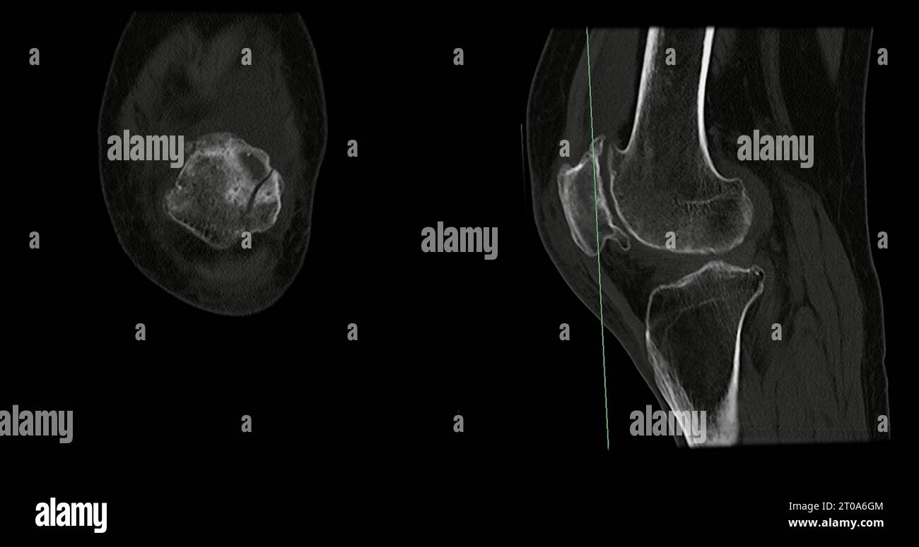 CT Scan of Knee joint sagittal and coronal in case fracture patella ...