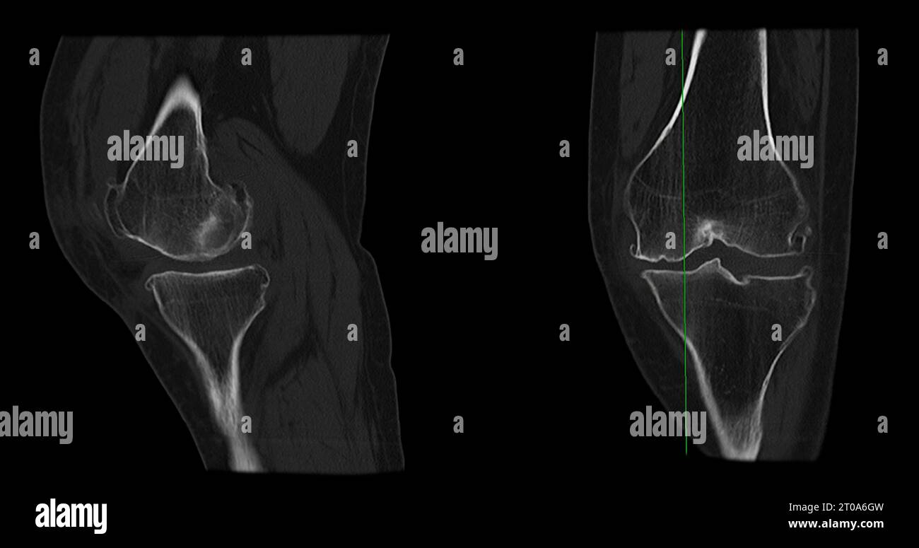 CT Scan of Knee joint sagittal and coronal in case fracture patella ...