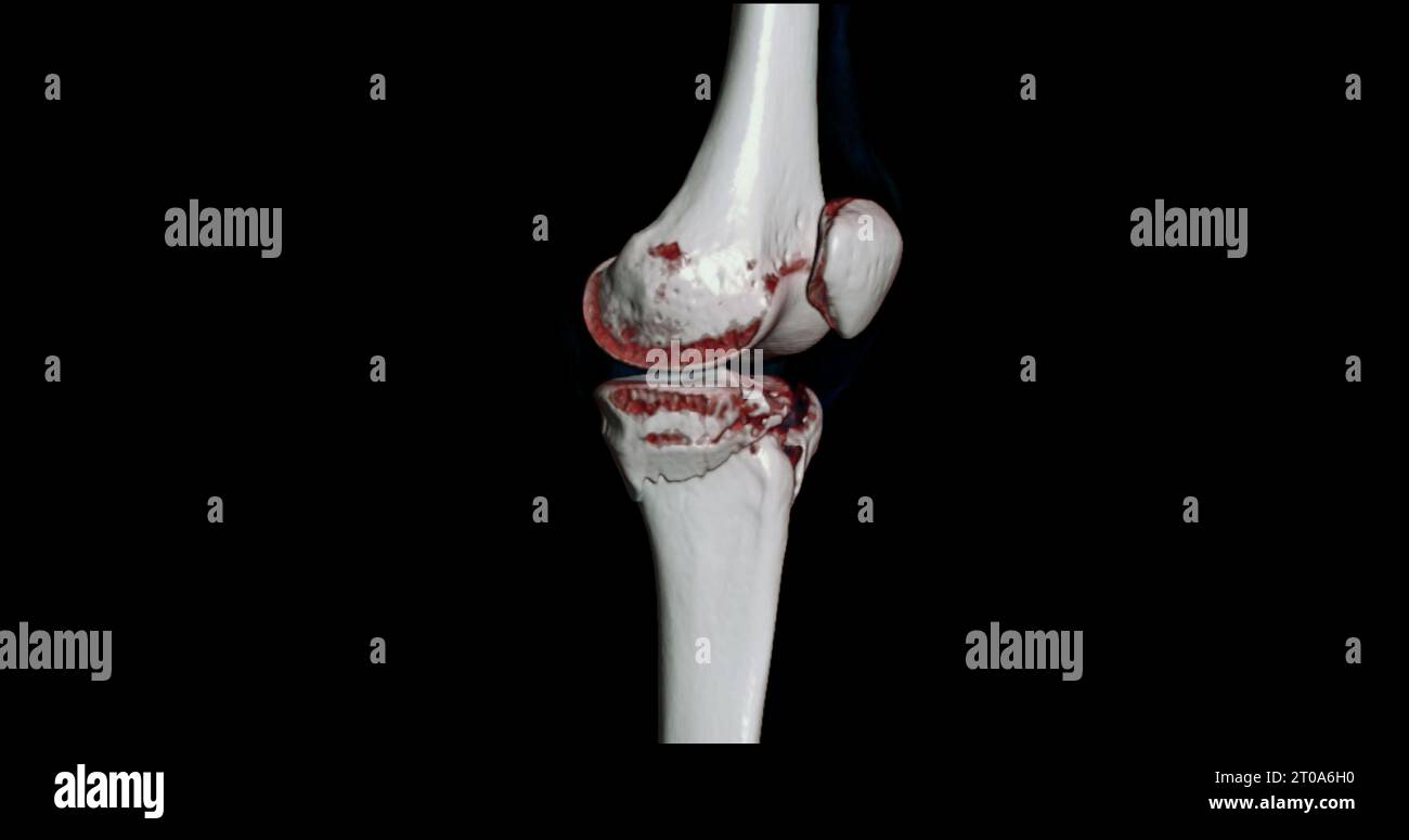 CT Scan of Knee joint showing fracture tibia and fibula bone 3D rendering Stock Photo - Alamy