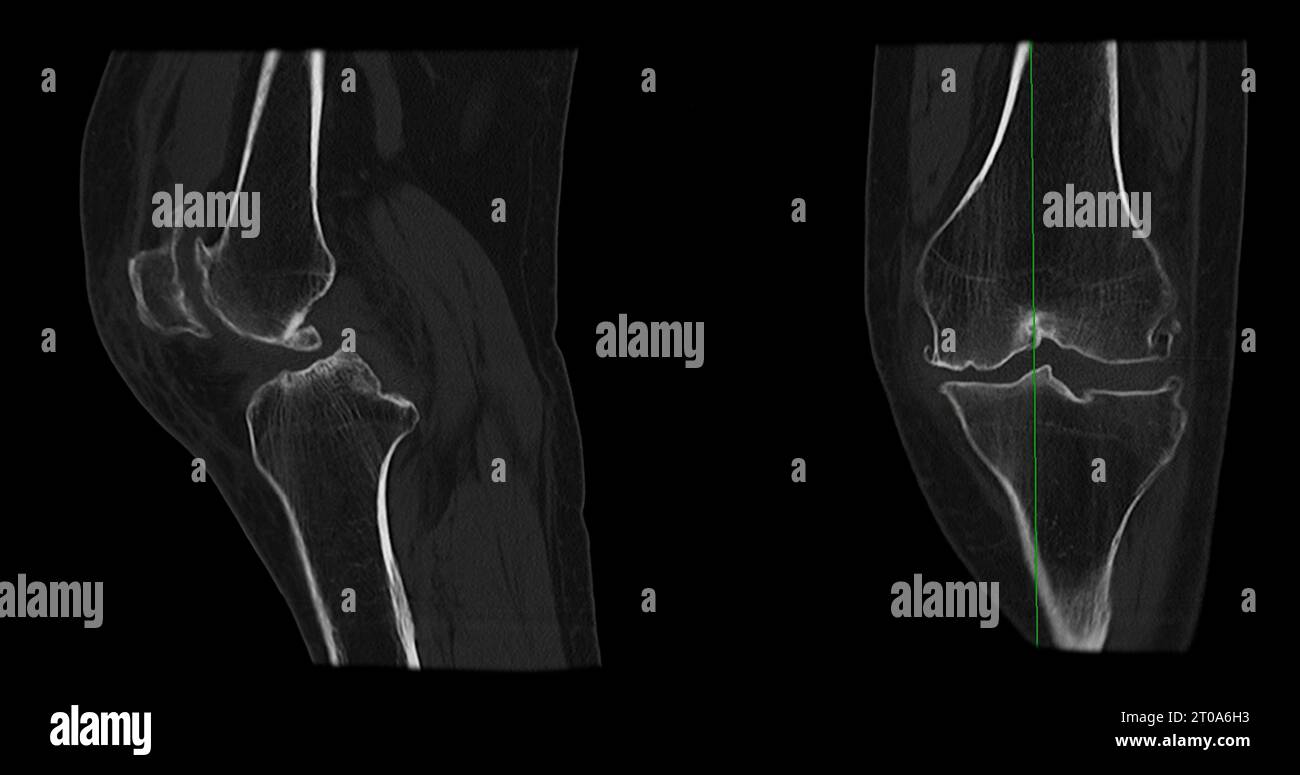 CT Scan of Knee joint sagittal and coronal in case fracture patella ...