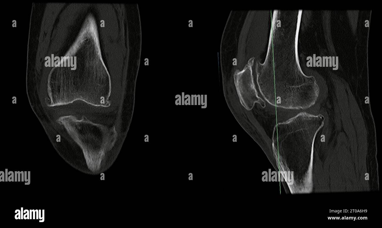 CT Scan of Knee joint sagittal and coronal in case fracture patella ...