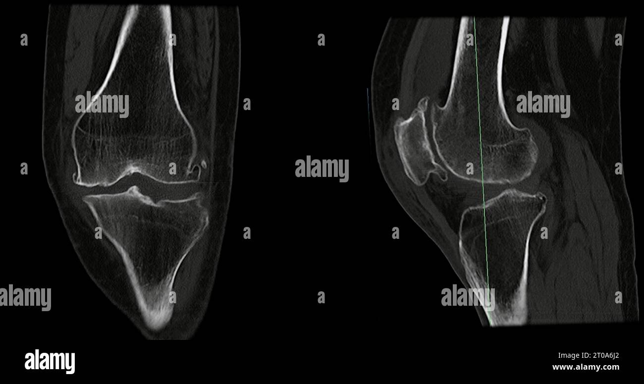 CT Scan of Knee joint sagittal and coronal in case fracture patella ...