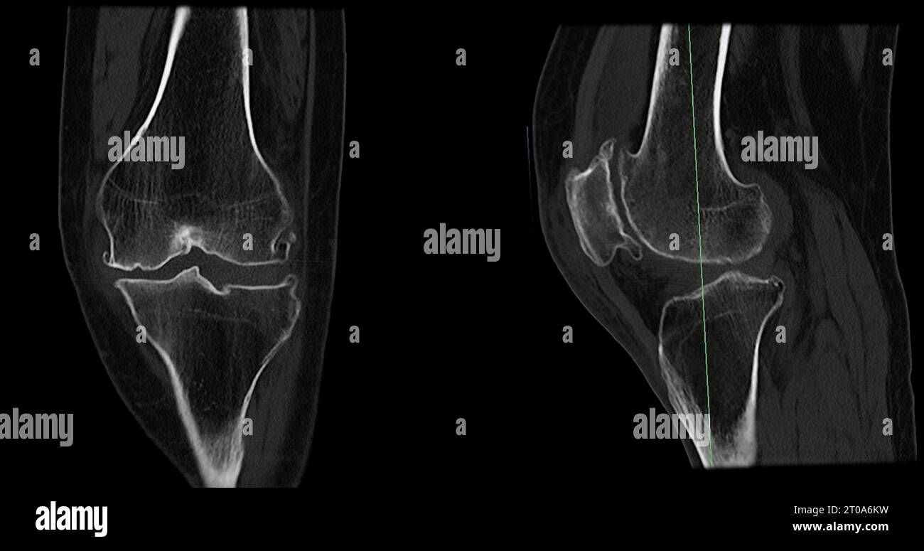 CT Scan of Knee joint sagittal and coronal in case fracture patella ...