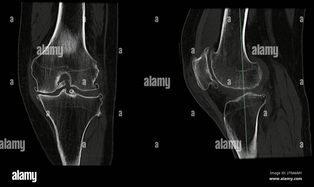 CT Scan of Knee joint sagittal and coronal in case fracture patella ...
