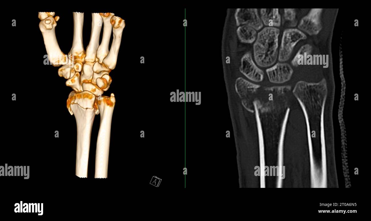 CT scan of wrist joint 3D rendering for diagnosis wrist joint pain Stock Photo - Alamy