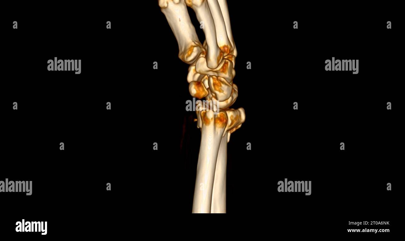 CT scan of wrist joint 3D rendering for diagnosis wrist joint pain ...
