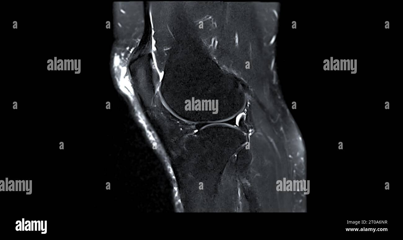 Magnetic resonance imaging or MRI of knee joint c for detect tear or ...