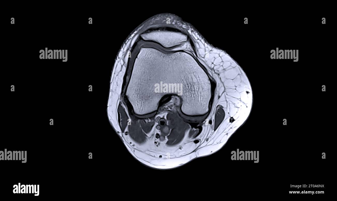 Magnetic resonance imaging or MRI of knee joint c for detect tear or ...