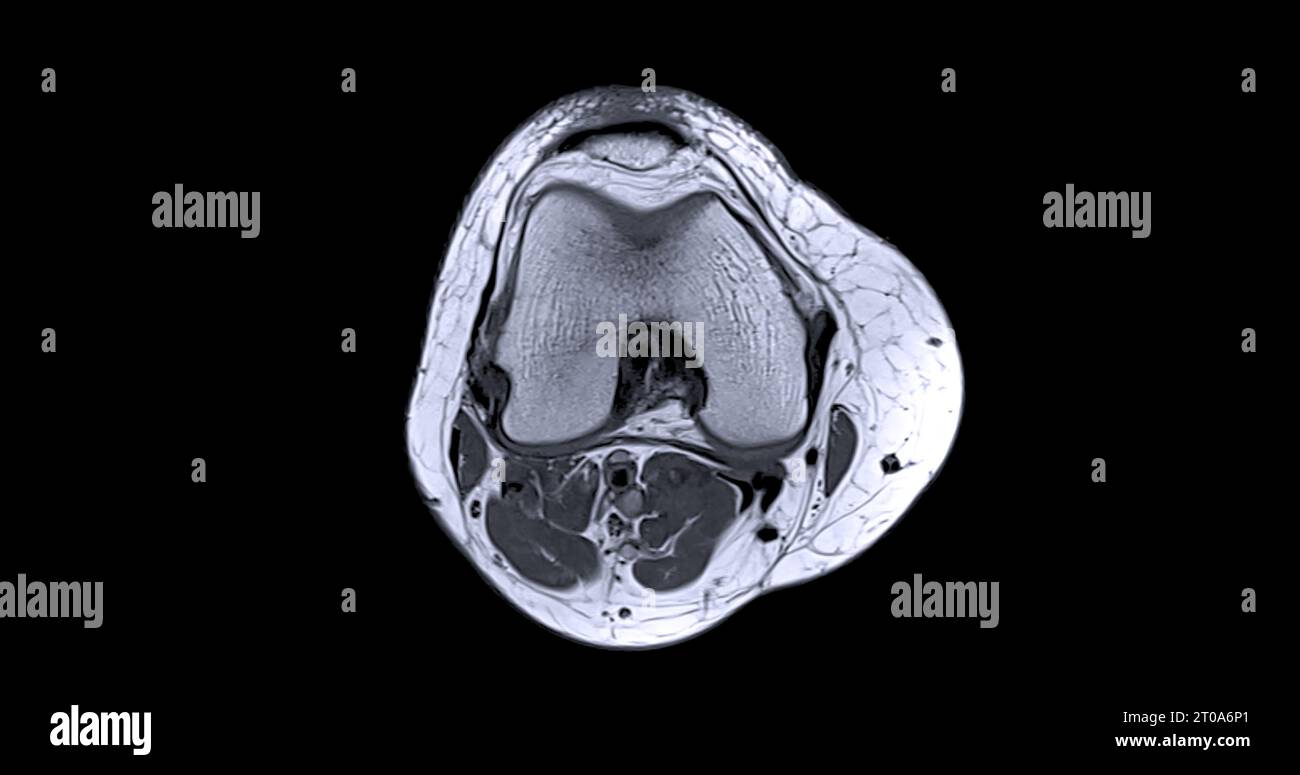 Magnetic resonance imaging or MRI of knee joint c for detect tear or ...