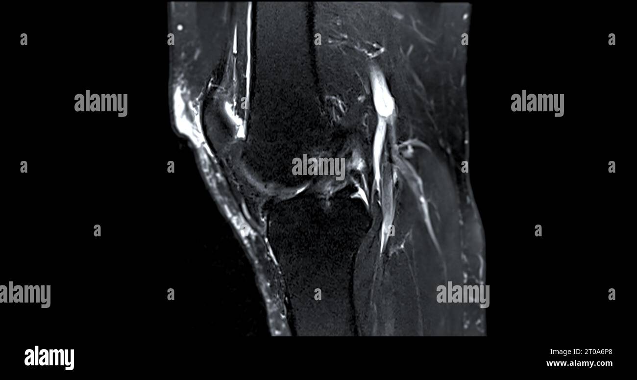 Magnetic resonance imaging or MRI of knee joint c for detect tear or ...