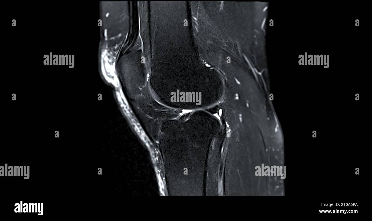 Magnetic resonance imaging or MRI of knee joint c for detect tear or ...