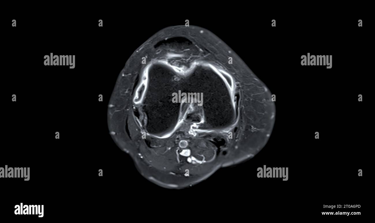 Magnetic resonance imaging or MRI of knee joint c for detect tear or ...