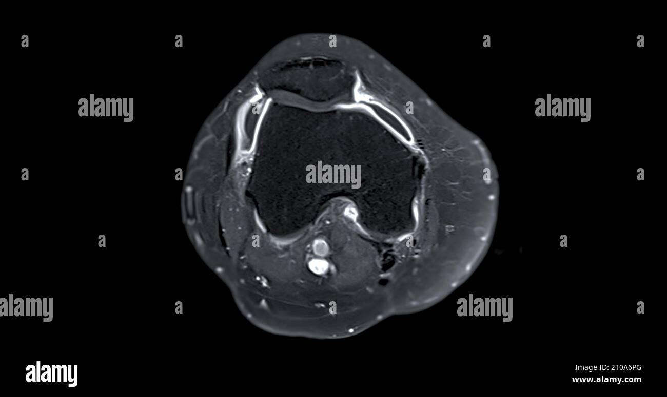 Magnetic resonance imaging or MRI of knee joint c for detect tear or ...