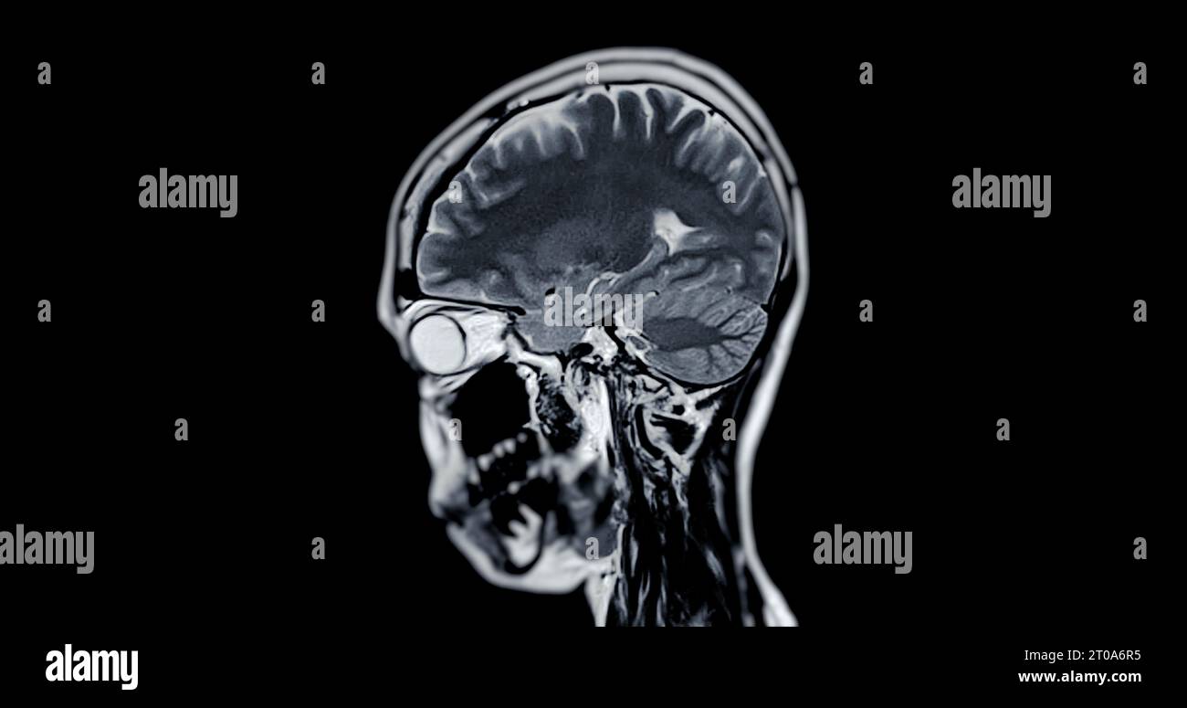 MRI scan of the brain for detect Brain diseases sush as stroke disease ...
