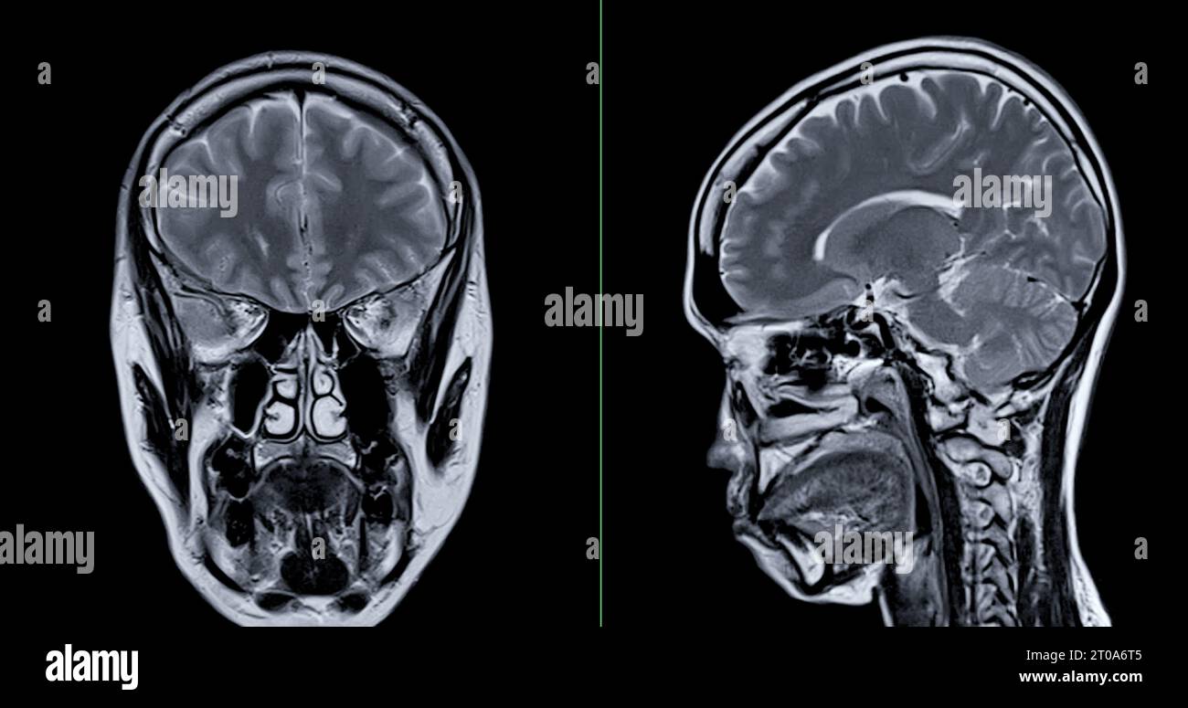 MRI scan of the brain for detect Brain diseases sush as stroke disease ...
