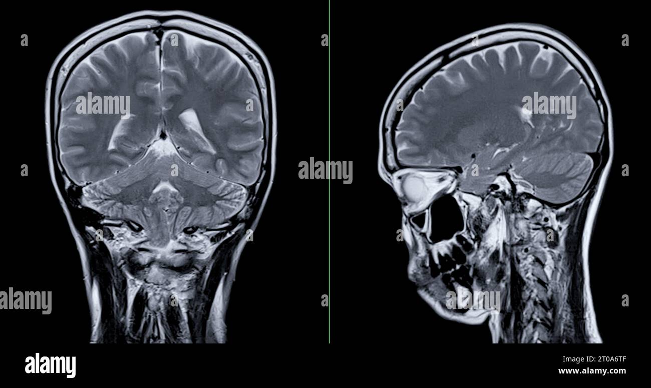 MRI scan of the brain for detect Brain diseases sush as stroke disease ...