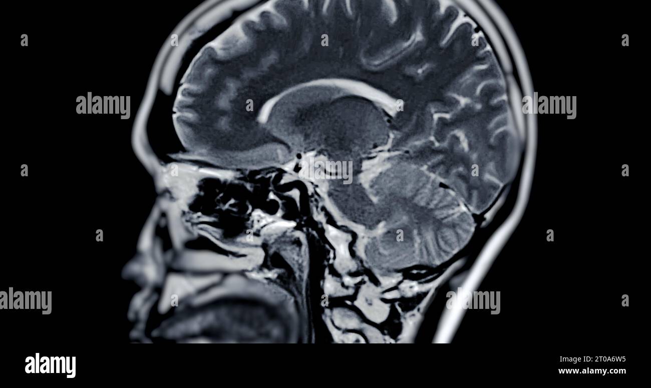 MRI scan of the brain for detect Brain diseases sush as stroke disease ...