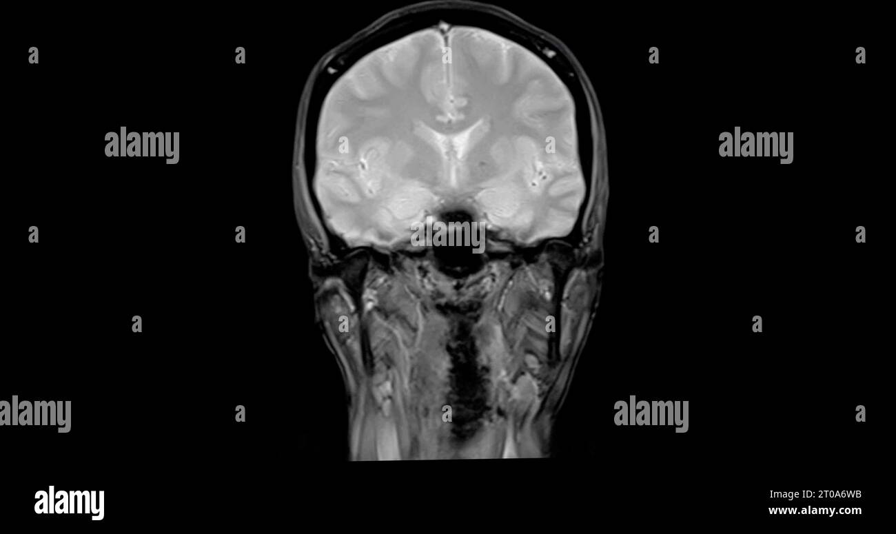 MRI scan of the brain for detect Brain diseases sush as stroke disease ...