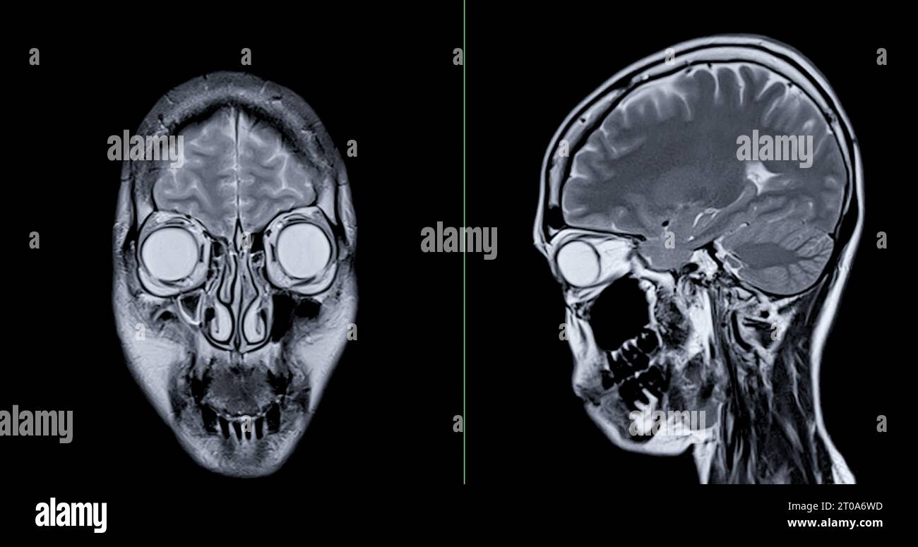 MRI scan of the brain for detect Brain diseases sush as stroke disease ...