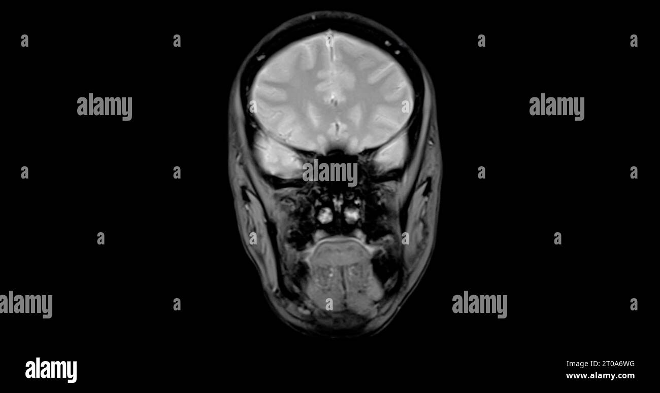 MRI scan of the brain for detect Brain diseases sush as stroke disease ...