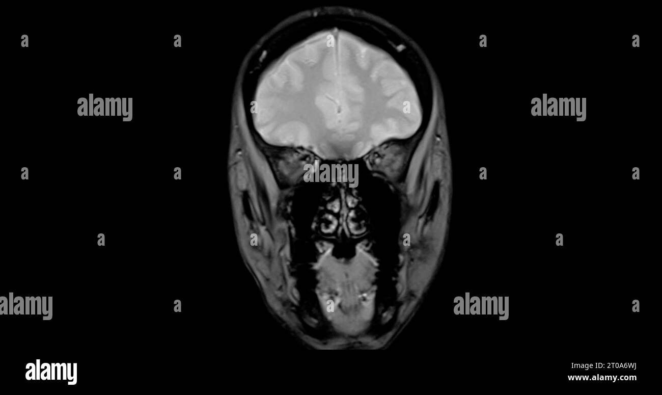 MRI scan of the brain for detect Brain diseases sush as stroke disease, Brain tumors and ...