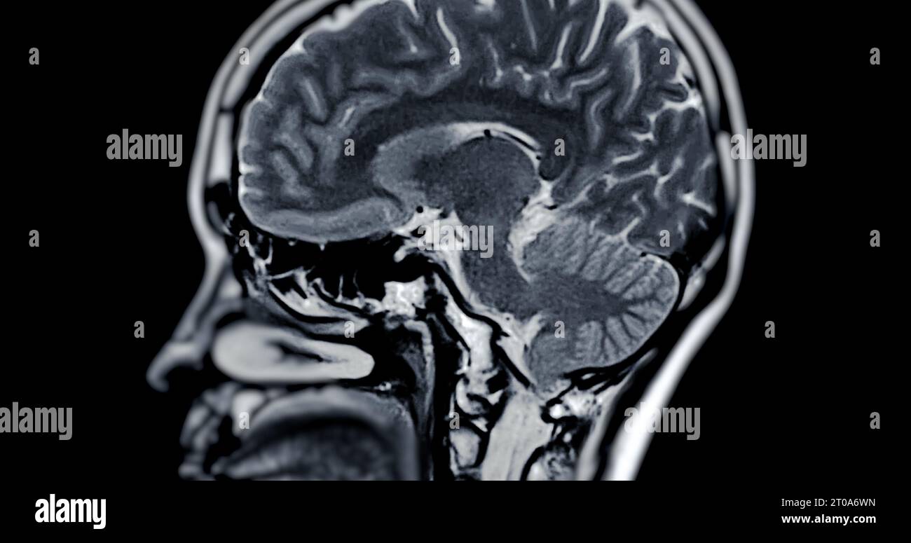 MRI scan of the brain for detect Brain diseases sush as stroke disease ...