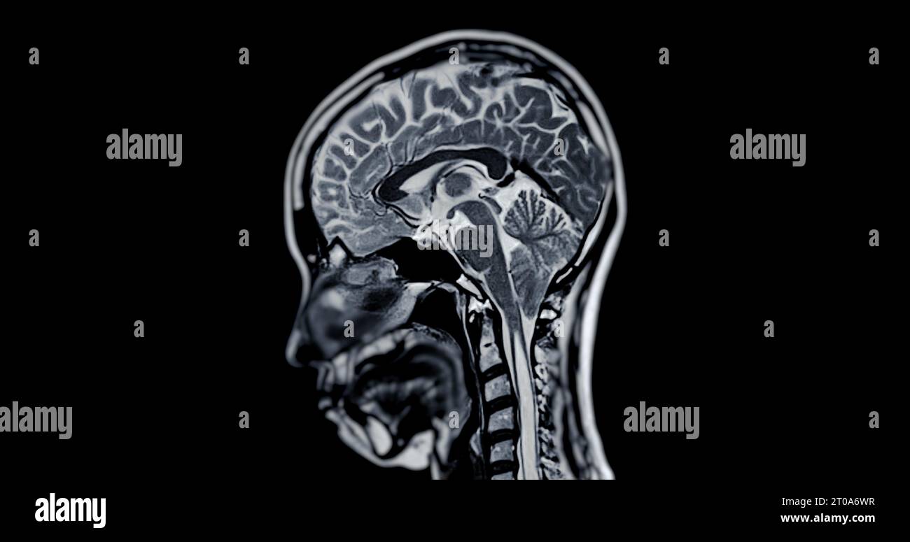 MRI scan of the brain for detect Brain diseases sush as stroke disease ...