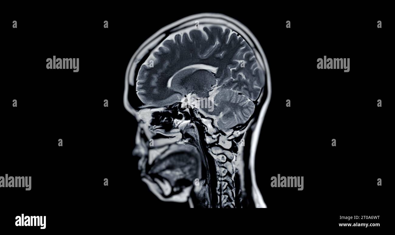 MRI scan of the brain for detect Brain diseases sush as stroke disease ...