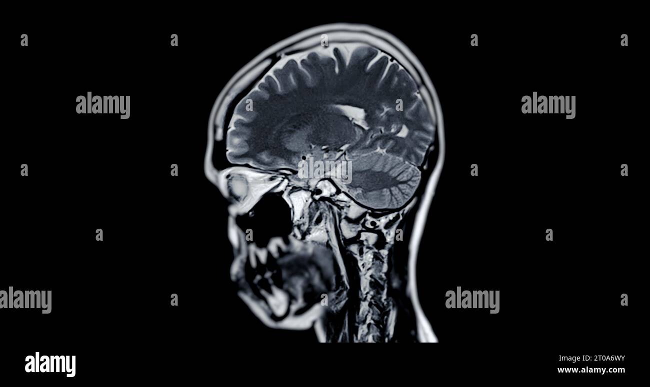 MRI scan of the brain for detect Brain diseases sush as stroke disease ...
