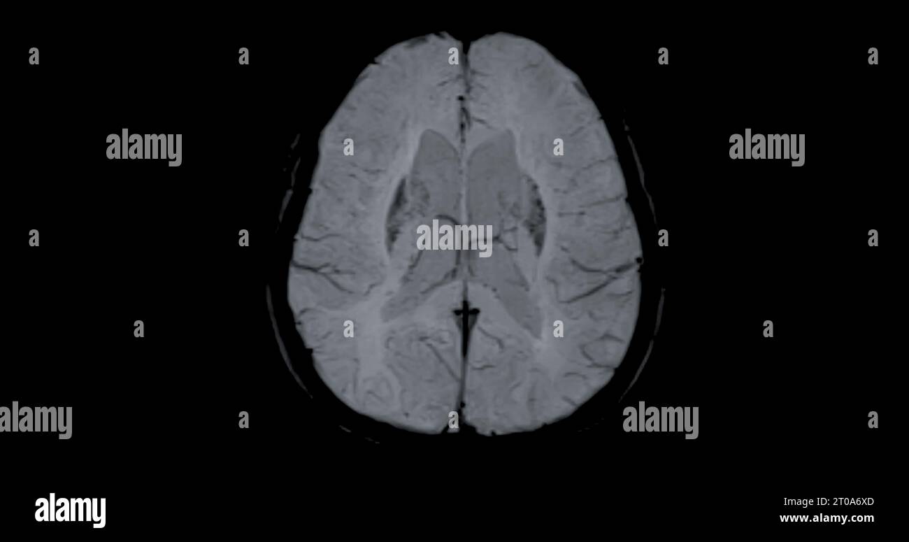 MRI scan of the brain for detect Brain diseases sush as stroke disease ...