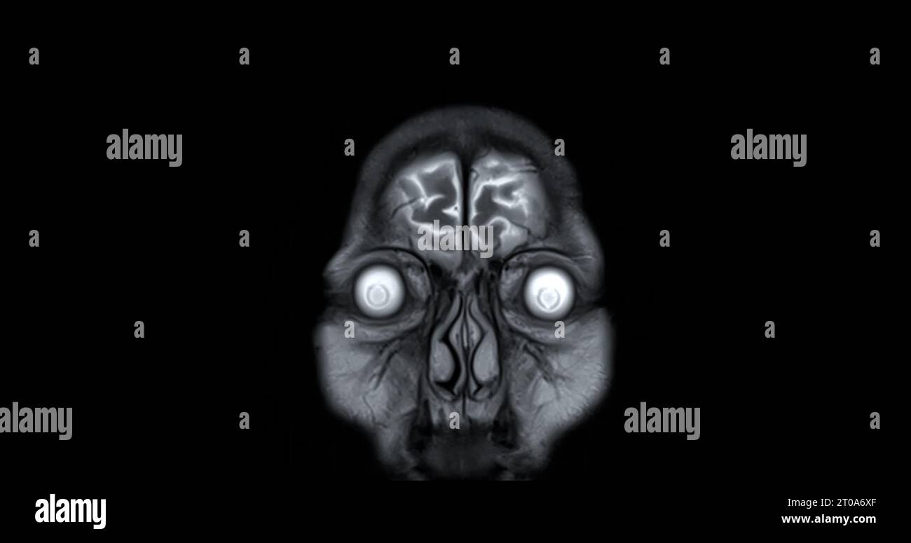 MRI scan of the brain for detect Brain diseases sush as stroke disease ...