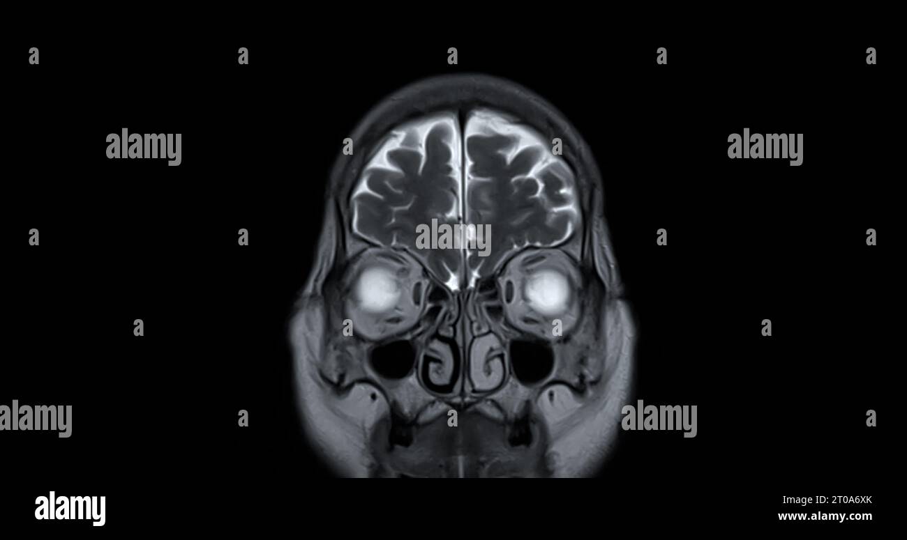 MRI scan of the brain for detect Brain diseases sush as stroke disease ...