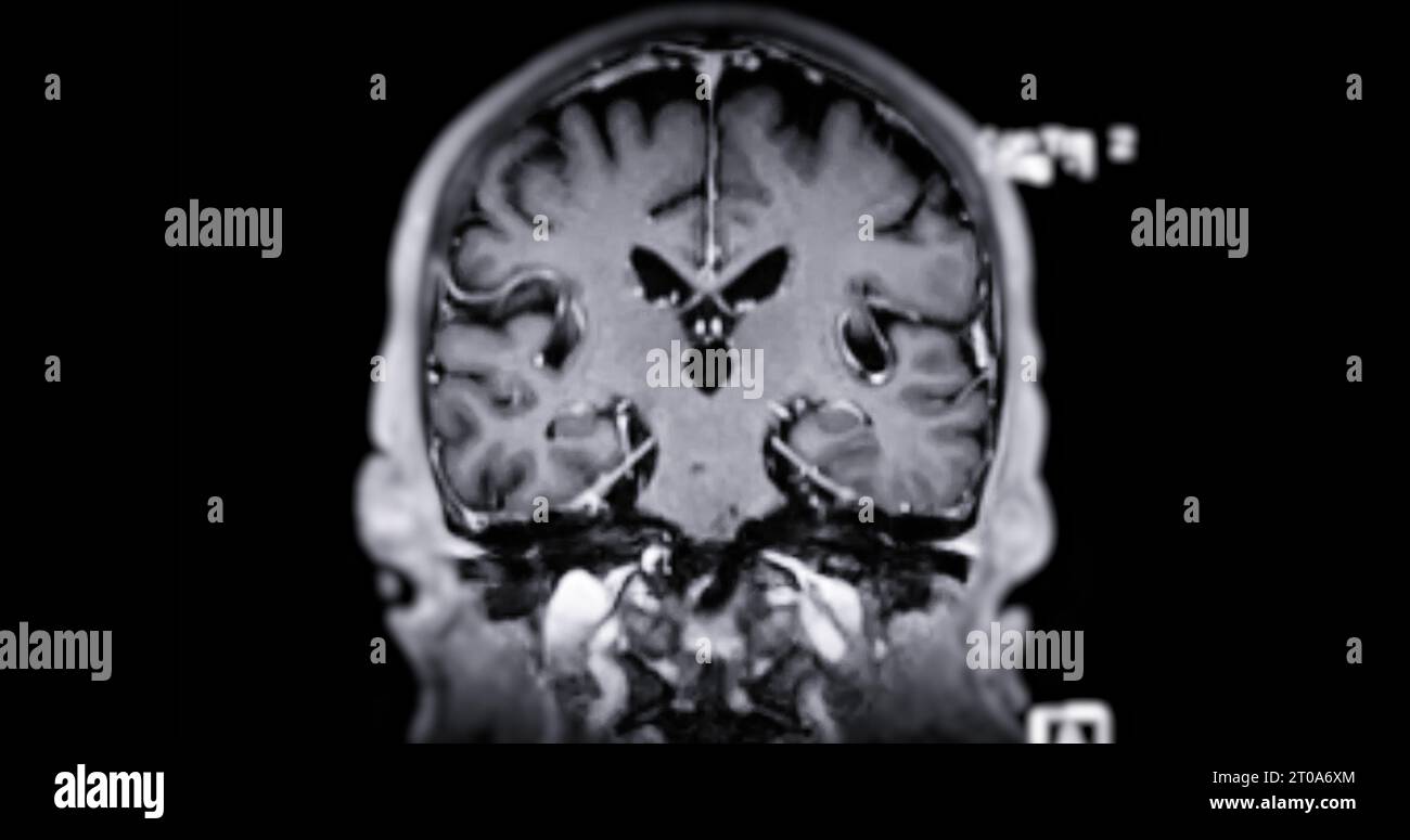 MRI scan of the brain for detect Brain diseases sush as stroke disease ...