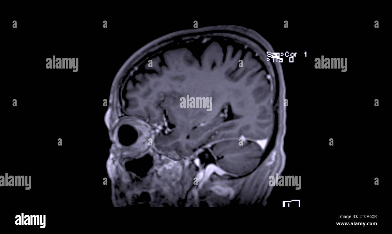 MRI scan of the brain for detect Brain diseases sush as stroke disease ...